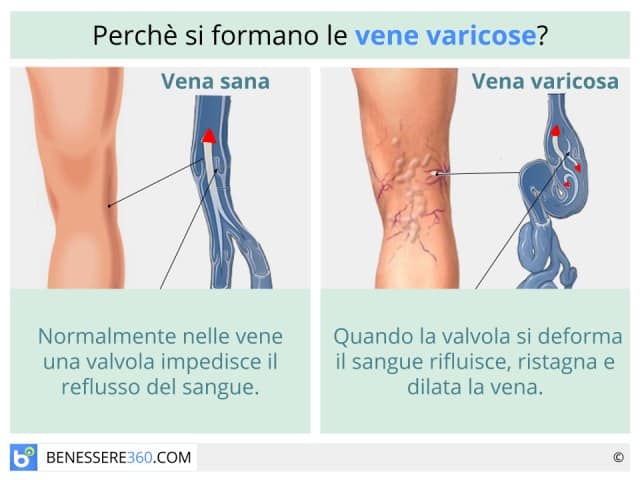 Vene varicose rimedi naturali, sintomi e cause - Depurarsi Naturalmente