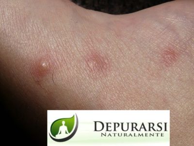 Verruche e porri della pelle: cosa fare? Contagio e rimedi naturali